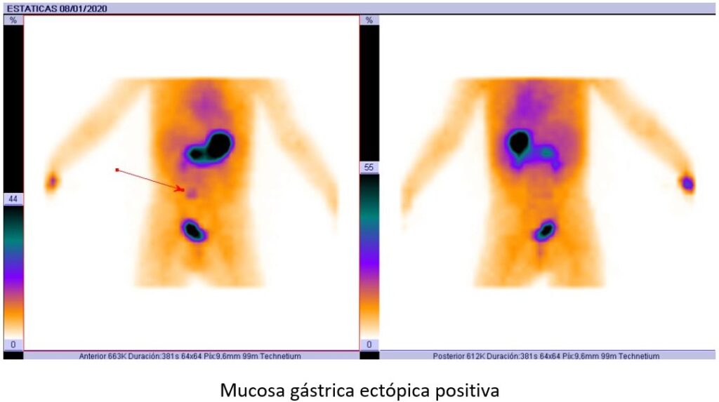 GAMMAGRAFÍA PARA LA DETECCIÓN MUCOSA GÁSTRICA ECTÓPICA – Centro Pet Salud